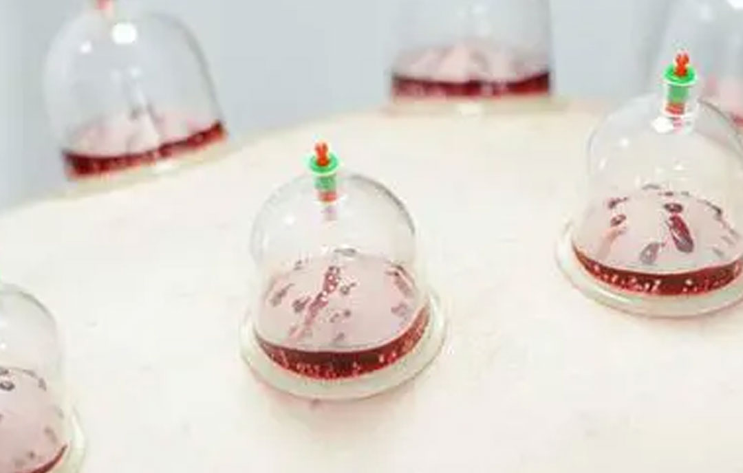 Hacamat nasıl yapılır? - Doğal Hayat Polikliniği